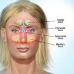 Sinusitis and nasal congestion - Homeopathic treatment by Dr. Tsan
