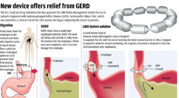 Treatment for GERD - Philadelphia Homeopathic Clinic - Dr. Tsan
