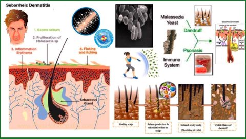 Treatment of seborrheic dermatitis at the Philadelphia Homeopathic Clinic